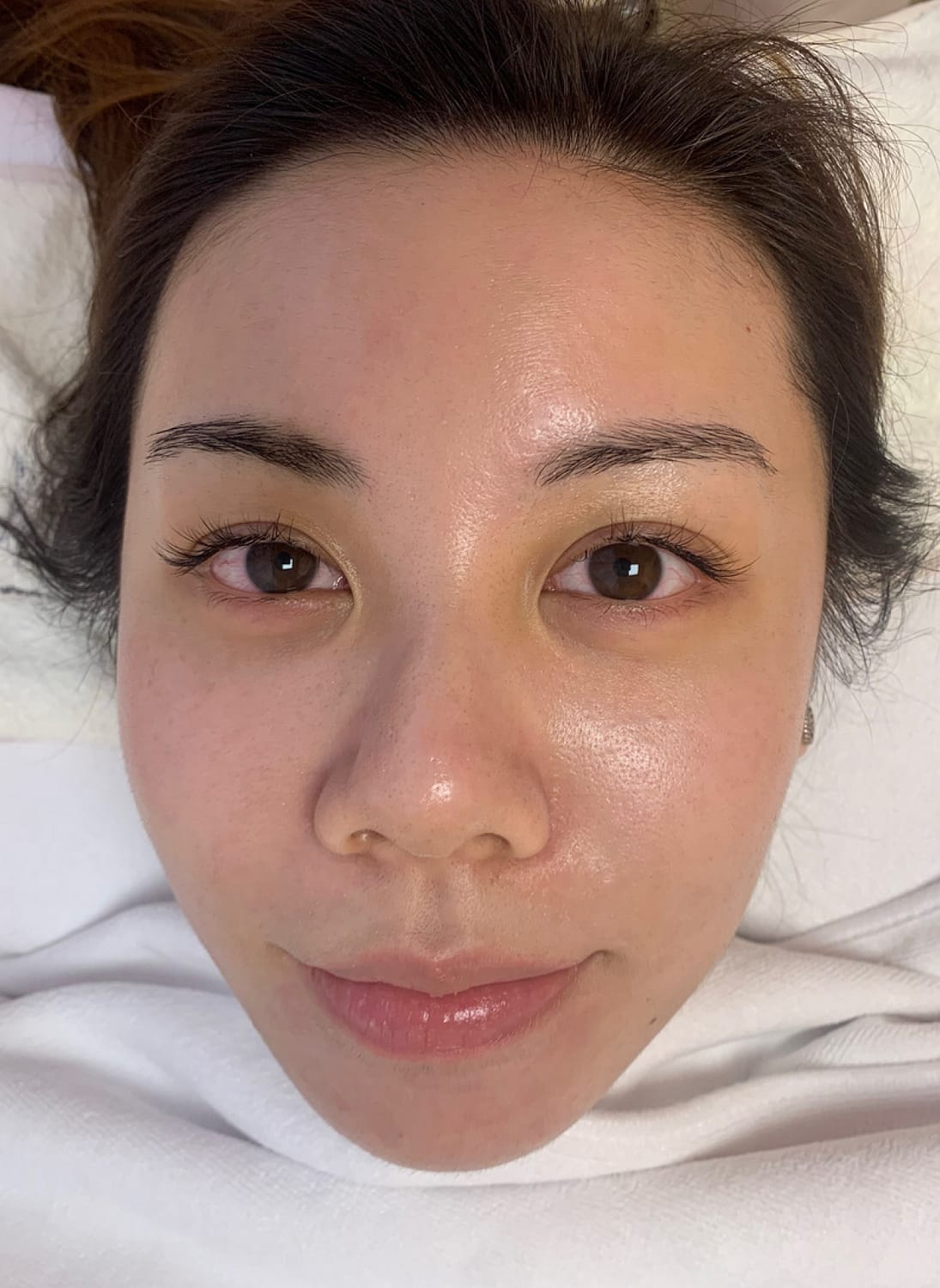 Acne Solution - Meso Beauty