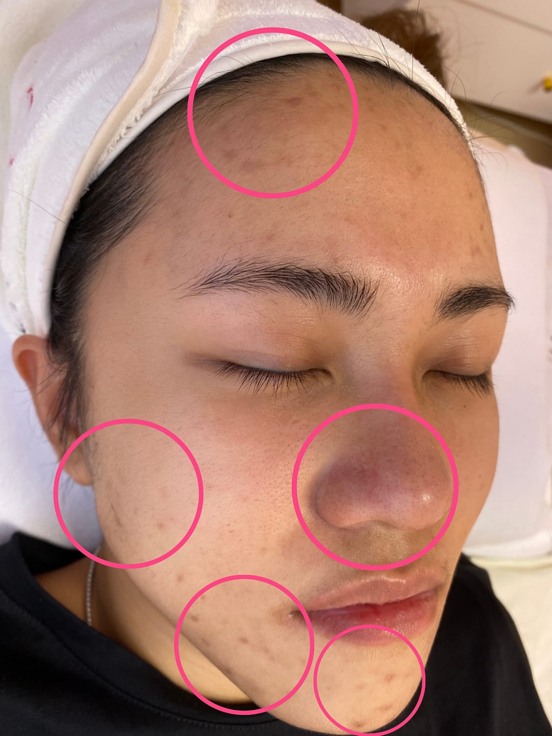 Acne Solution - Meso Beauty