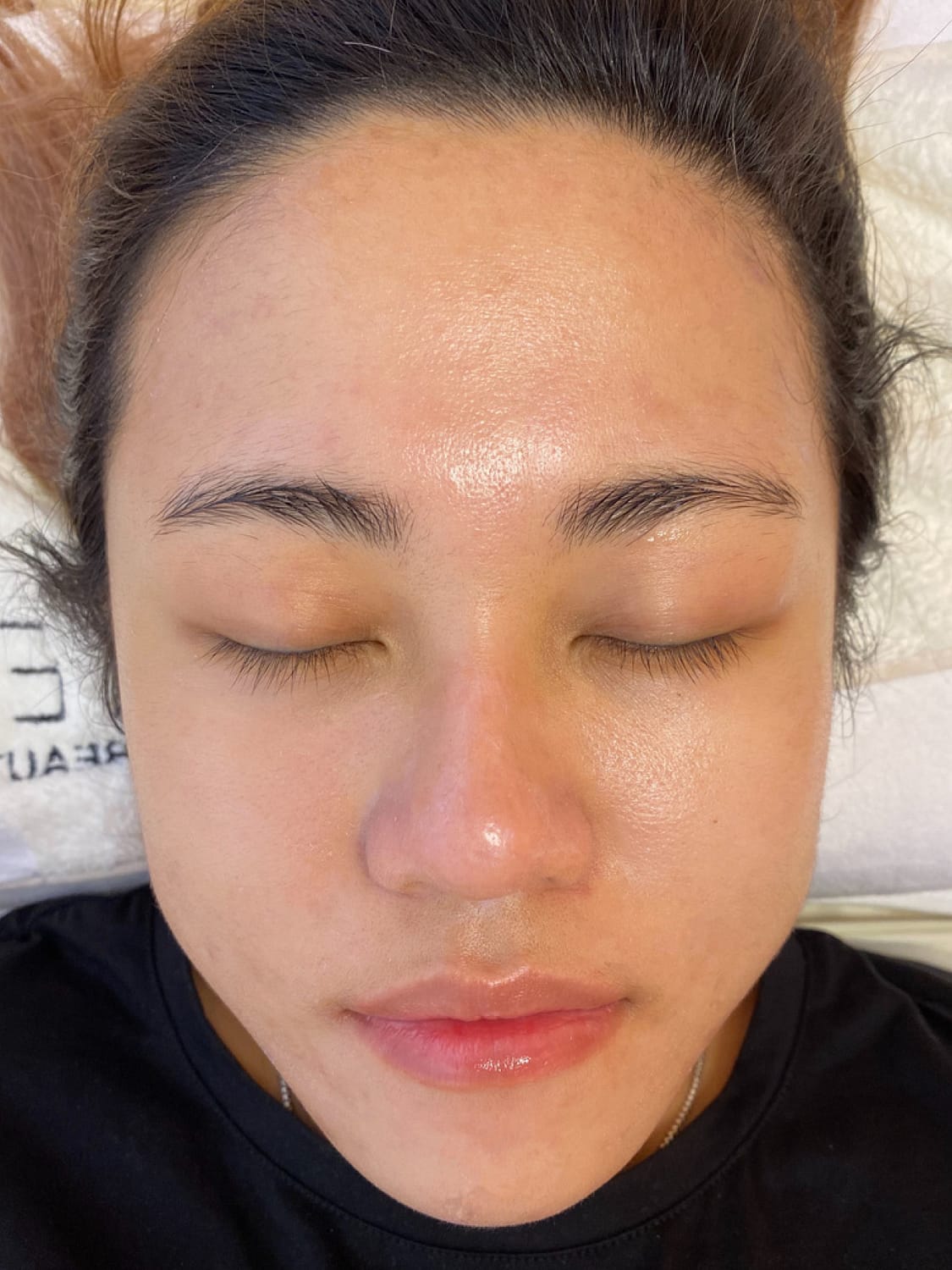 Acne Solution - Meso Beauty
